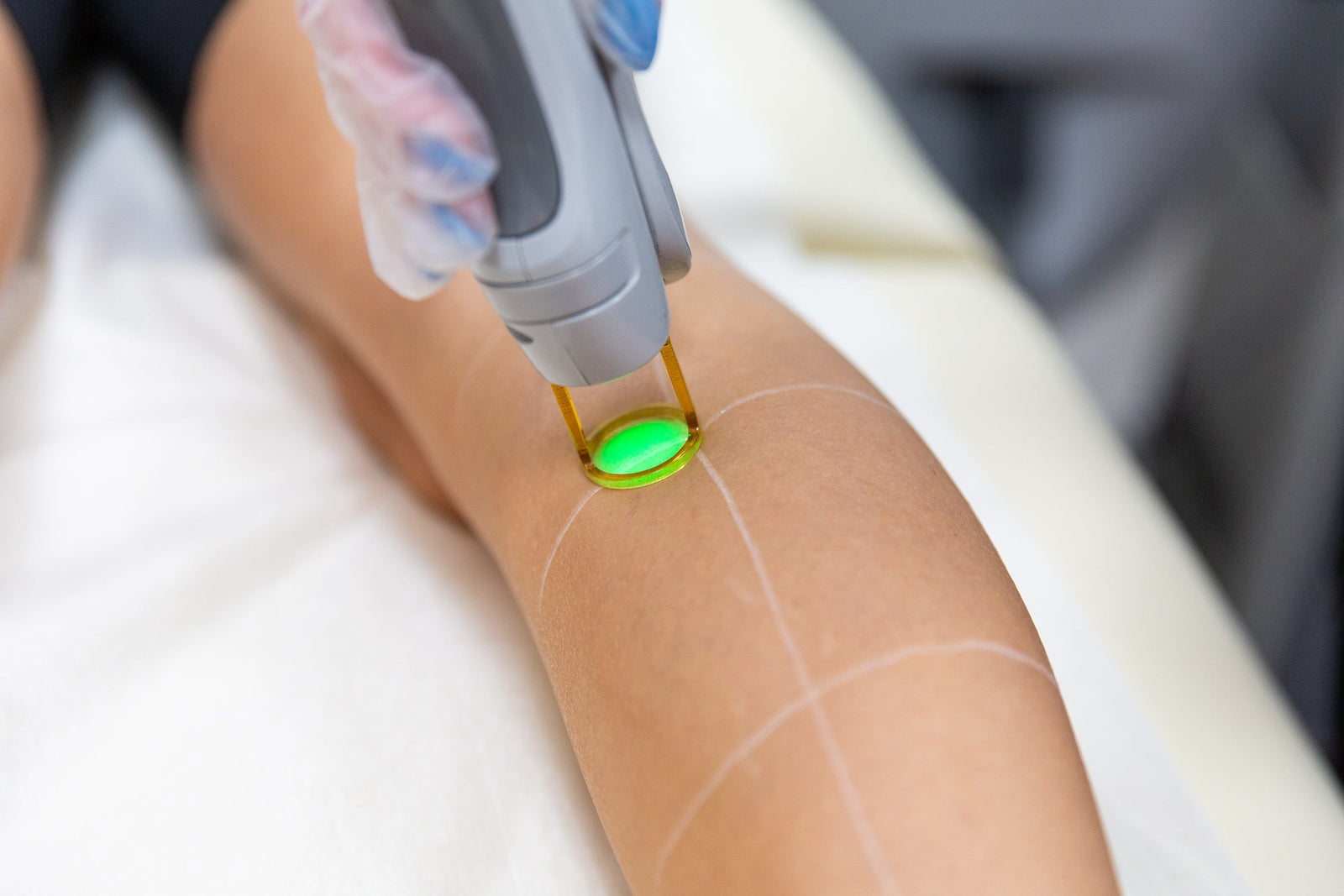 Understanding Bumps After Laser Hair Removal | Simplicity Laser
